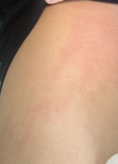 Is it really cellulitis? – differential diagnosis of a red leg | AIMED ...