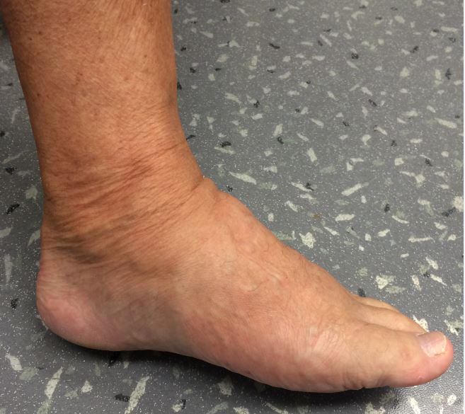 Trap – cellulitis or an acute Charcot’s foot ? | AIMED - Let's talk ...